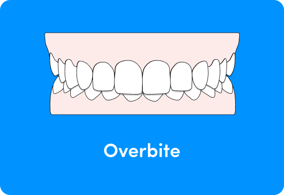 Aligners vs Braces: Discover the Best Option to Fix Overbites
