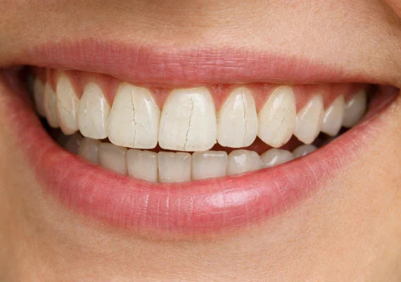 Brittle teeth: Causes, symptoms & solutions for weak teeth.
