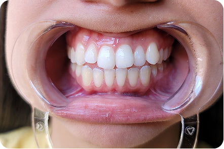 Edge‑to‑Edge Bite Correction With Caspersmile Clear Aligners