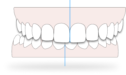 Fix midline shift teeth with Caspersmile clear aligners